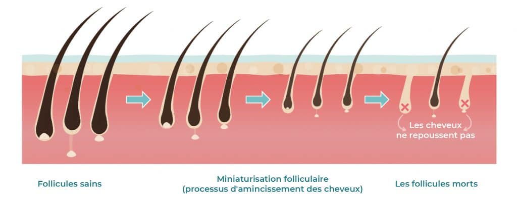 Calvitie - MediCapilar